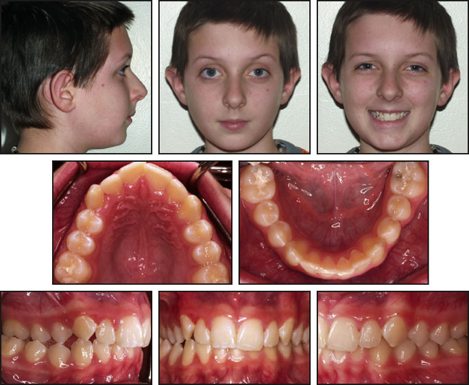 Correction of a Canted Lower Incisal Plane - Altis Group