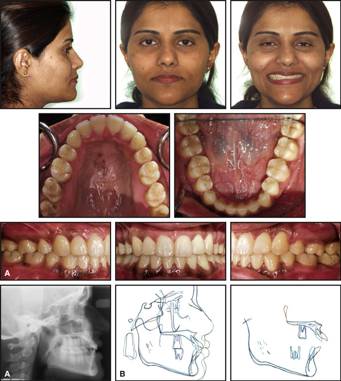 Treatment of Bimaxillary Protrusion Using Fiber-Reinforced Composite ...