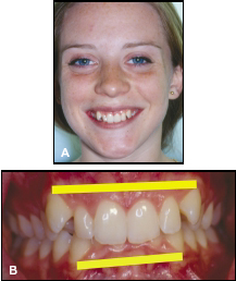 Treatment of Class II, Division 2 Malocclusion in Adults: Biomech ...