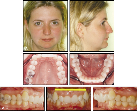 Treatment of Class II, Division 2 Malocclusion in Adults: Biomech ...