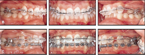 Treatment of Class II, Division 2 Malocclusion in Adults: Biomech ...